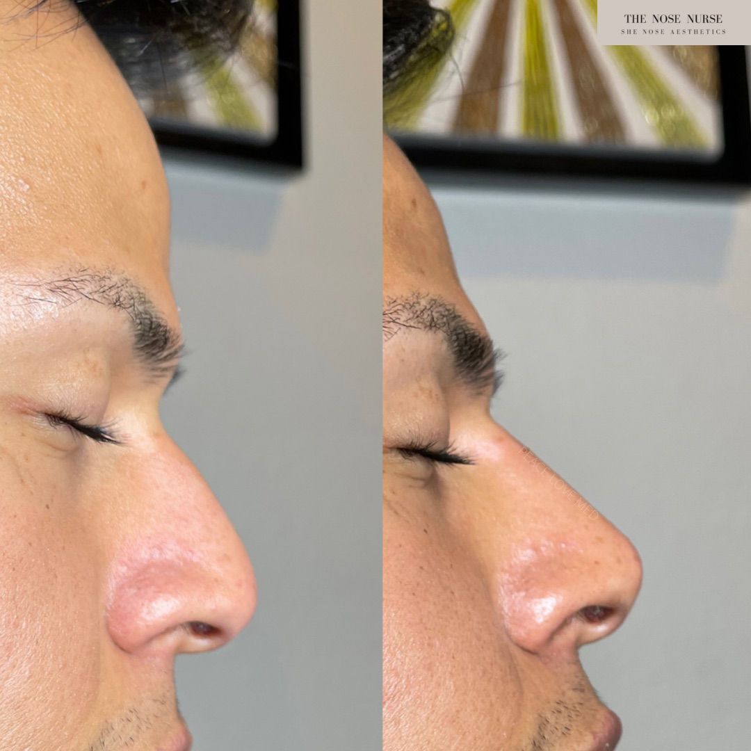 Non Surgical Nose Job Liquid Nose Job Boca Raton Thenosenurse