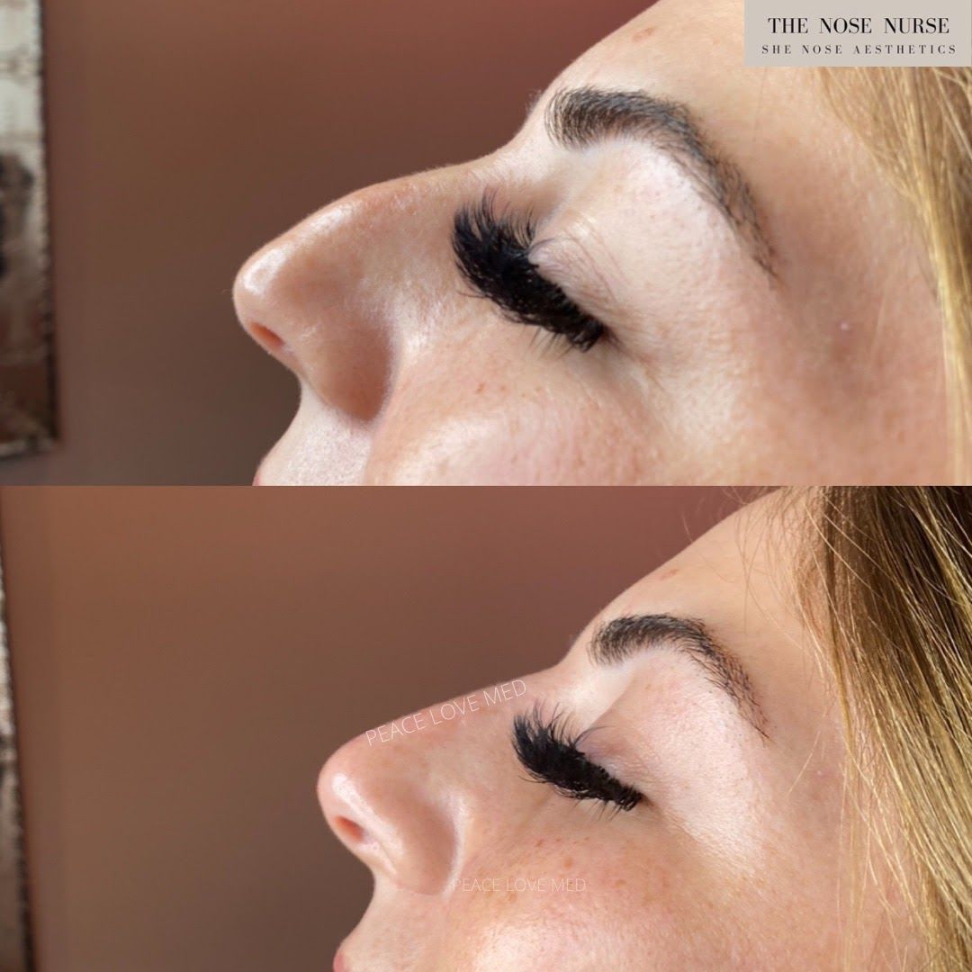 Non Surgical Nose Job Liquid Nose Job Boca Raton Thenosenurse