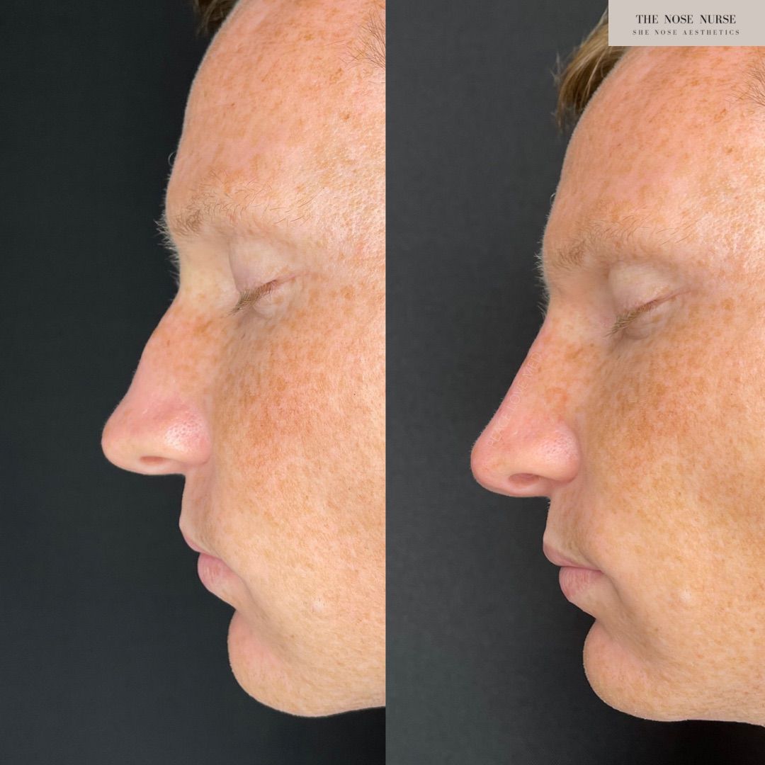 Non Surgical Nose Job Liquid Nose Job Boca Raton Thenosenurse