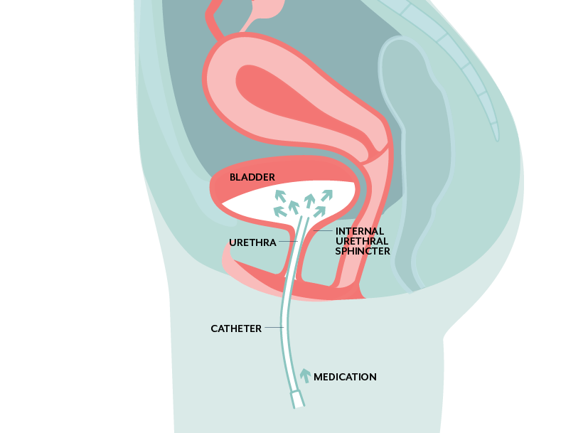 Treatment For Interstitial Cystitis Philadelphia Holistic Clinic Dr