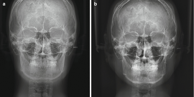 Alloplastic Augmentation Of The Chin And Mandible Plastic Surgery Key