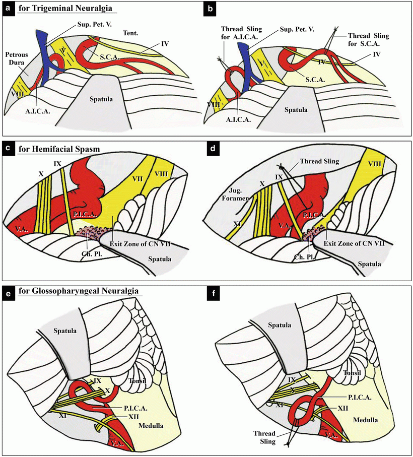 Anatomy For Microvascular Decompression Procedures Relationships