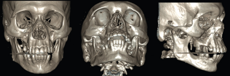 15 Zygomatic And Zygomaticomaxillary Complex Zmc Fractures Plastic