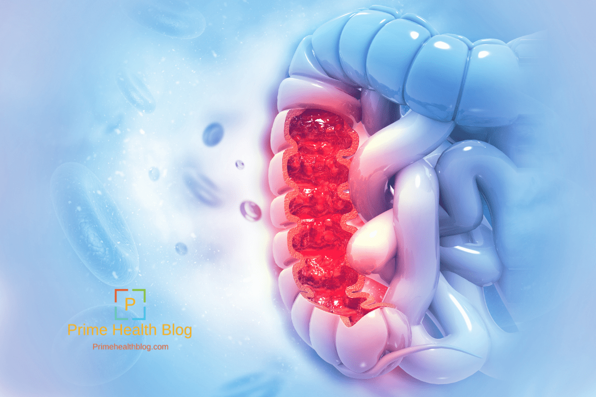 Colorectal Colon Cancer Symptoms Causes Types And Treatment