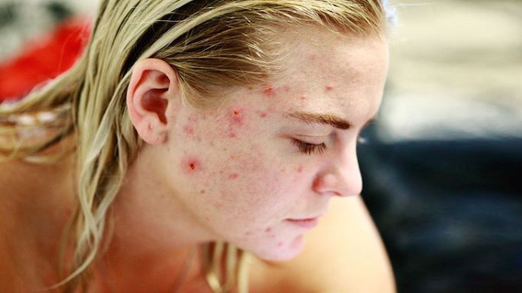 Causes Acne How Does Acne Go Away How To Prevent Acne Formation