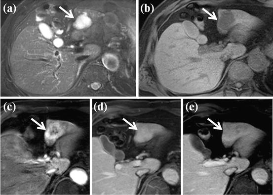 Imaging Of Hepatocellular Carcinoma Radiology Key