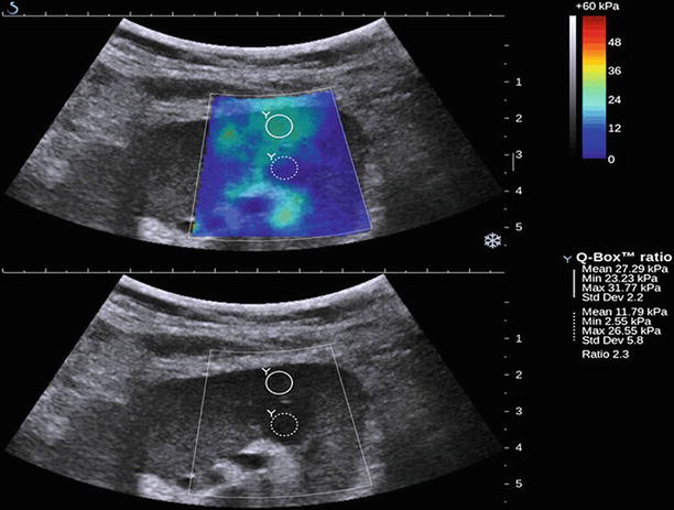 Contrast Enhanced Ultrasound Ceus And Elastographic Imaging