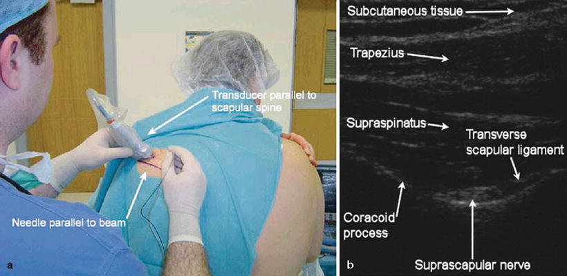 Suprascapular Nerve Block Radiology Key