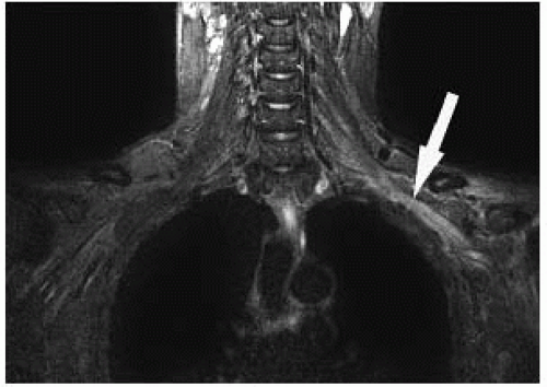 Brachial Plexus Radiology Key