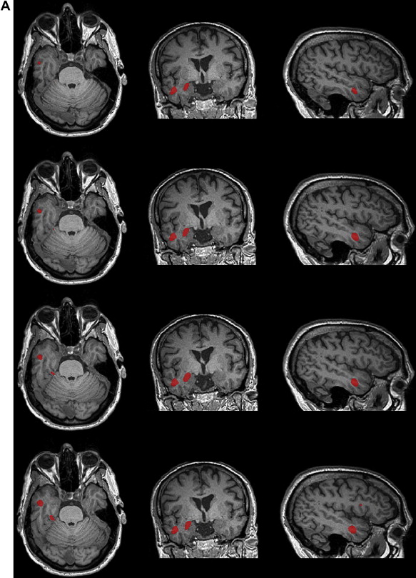 The Clinical Role Of Fusion Imaging Using Pet Ct And Mr Imaging