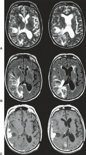 Adult Brain Tumors Radiology Key