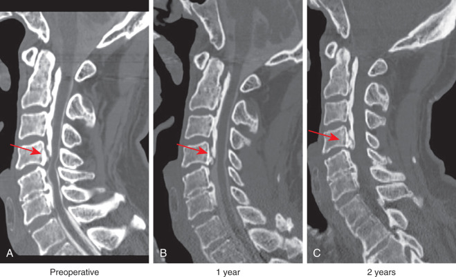 Ossification Of The Posterior Longitudinal Ligament Radiology Key