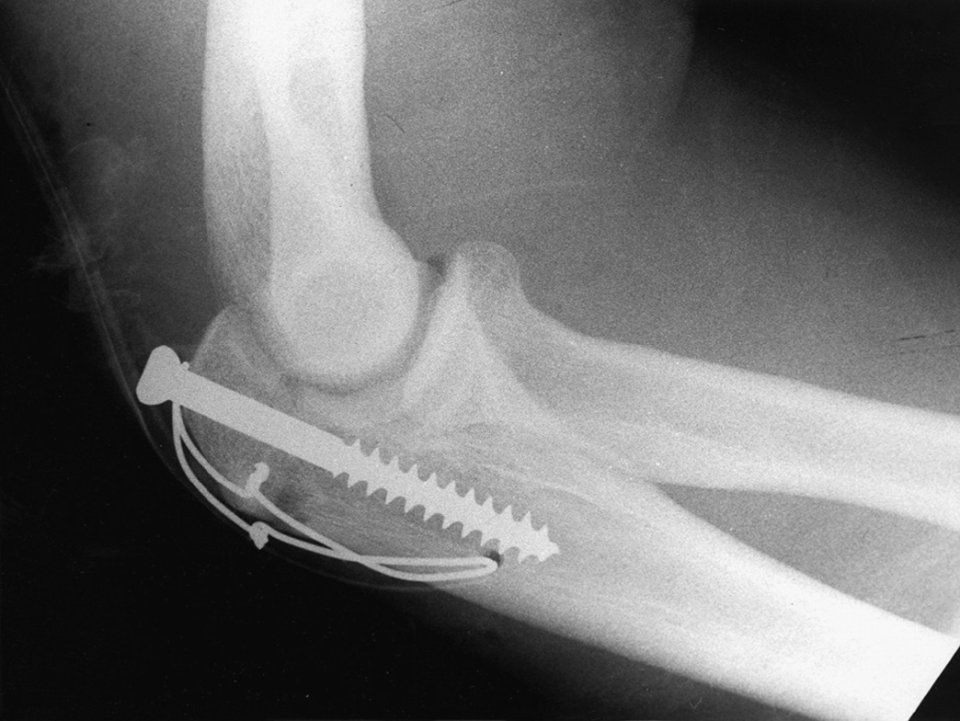 3 Fracture Fixation Radiology Key