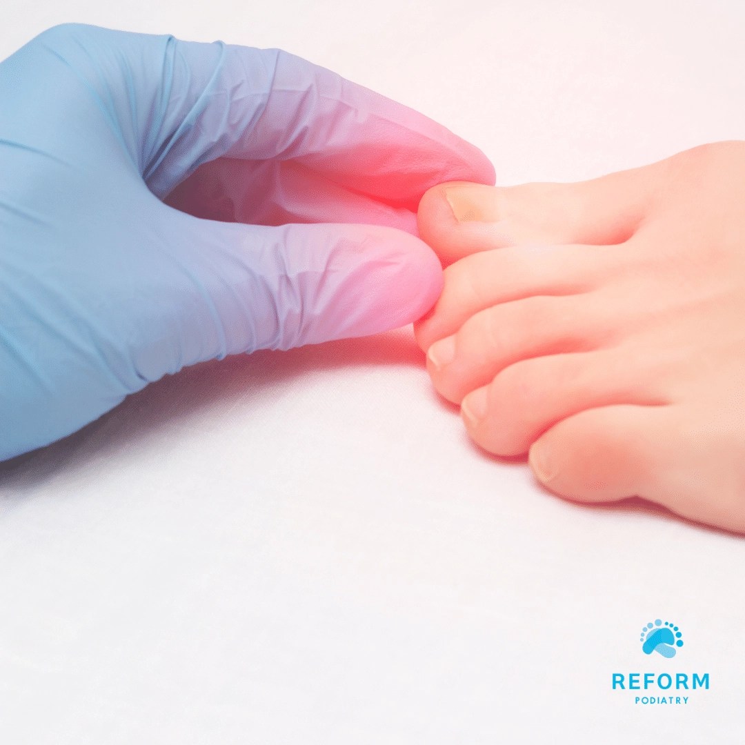 Ingrown Toenails And How To Fix Them Reform Podiatry