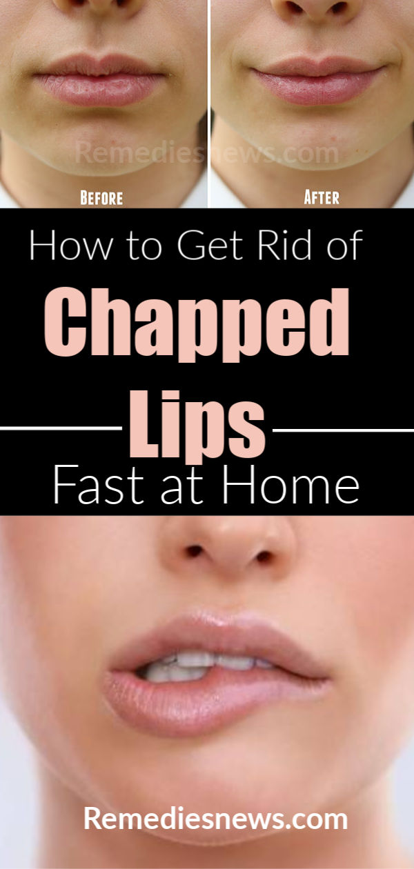 7 Natural Remedies To Get Rid Of Chapped Lips Fast At Home