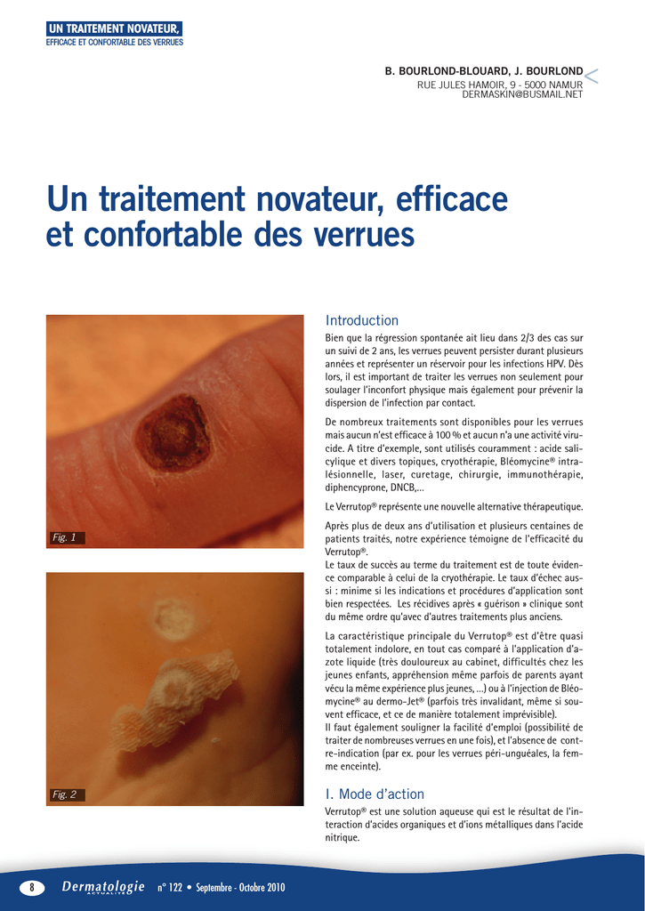 Quels Sont Les Différents Types De Traitement De La Verrue Wkcn