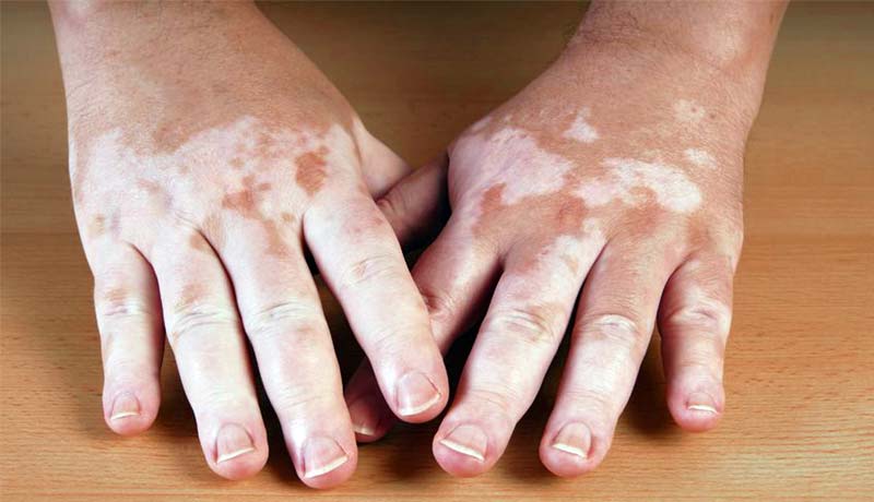 O Que é Vitiligo Conheça Os Sintomas E Tratamentos Osasco Notícias