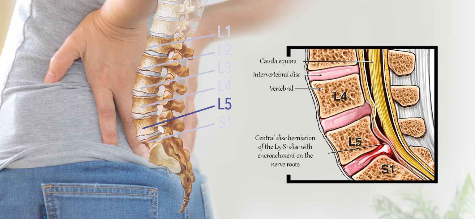 L5 S1 Disc Bulge Slip Disc Stenosis And Spondylolisthesis