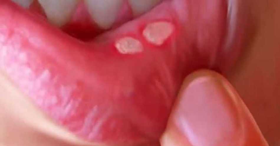 Mouth Ulcers Symptoms Causes And Treatmentsmarham