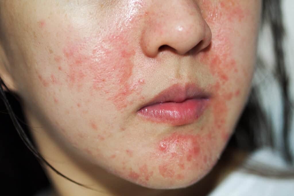 Skin Irritation 5 Natural Ways To Soothe Irritated Skin