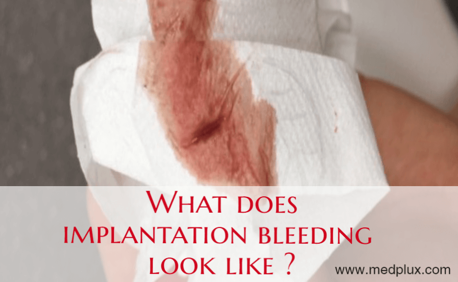 Implantation Bleeding Examples