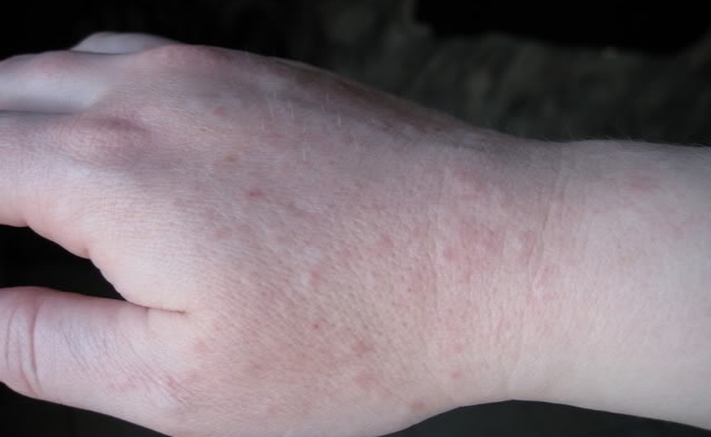 Anxiety Rash On Hands