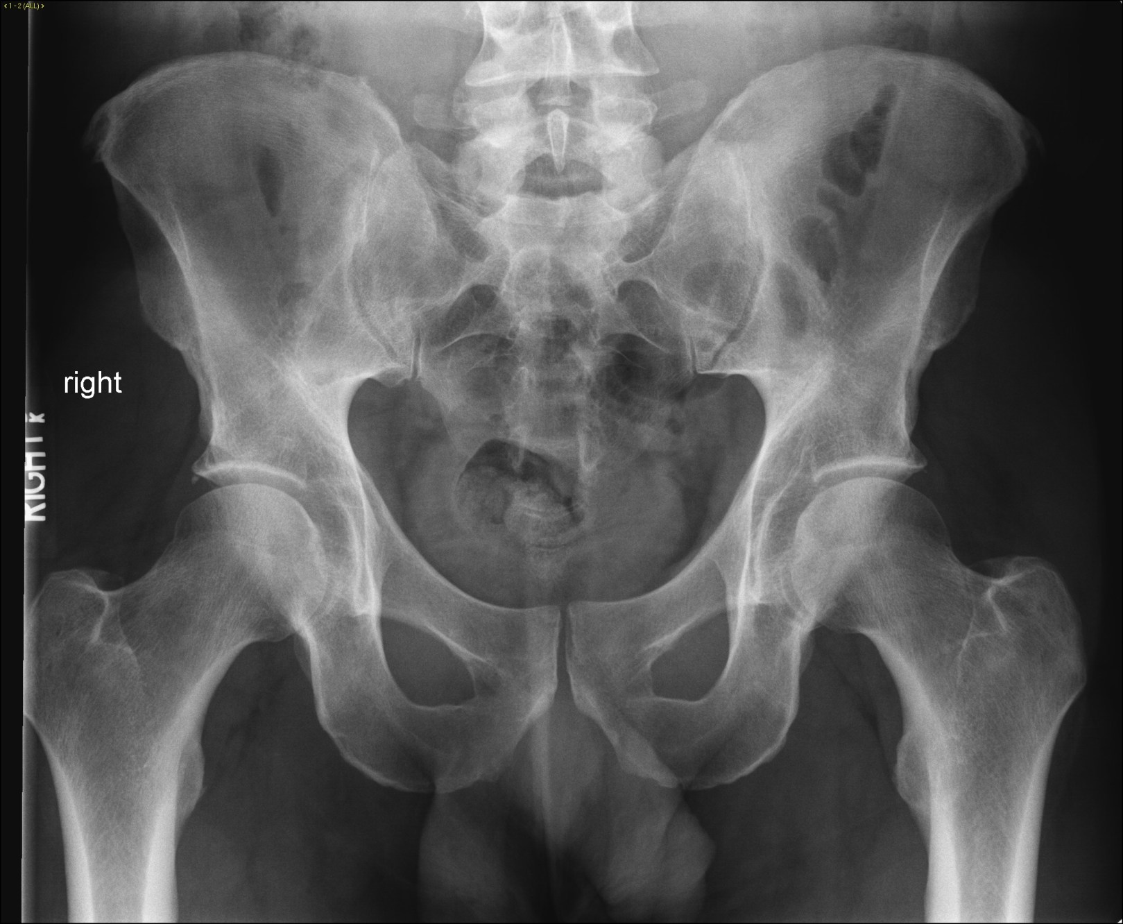 Ap Pelvis Radiograph