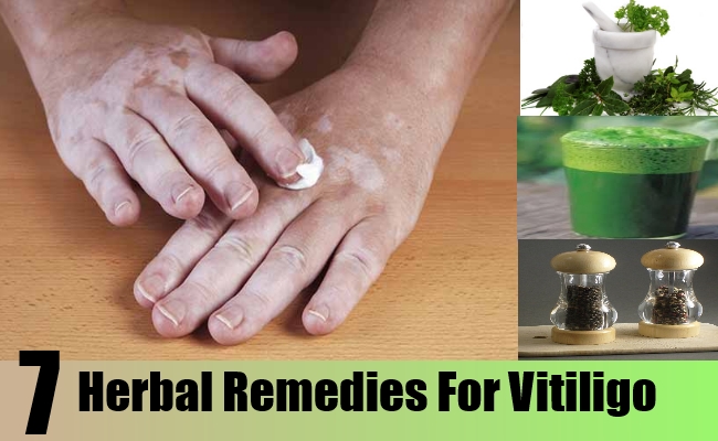 7 Effective Herbal Remedies For Vitiligo Natural Home Remedies