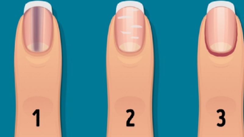 8 Things Your Nails Can Tell You About Your Health Video