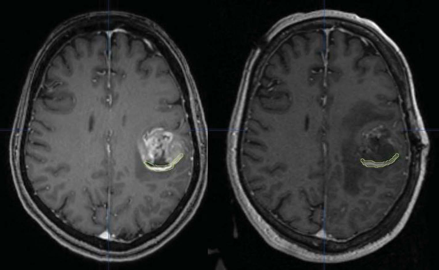 Use Of High Field Intraoperative Magnetic Resonance Imaging To Enhance