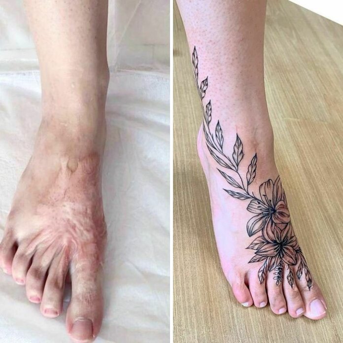 Tattoo Artists Created Amazing Scar And Birthmark Cover Up Tattoos