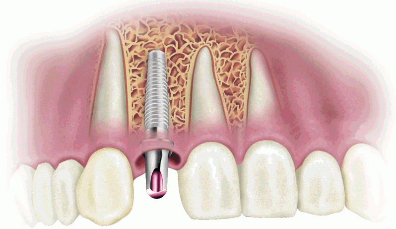 Complicaciones En Implantes Clínica Dental Urculo Burgaz