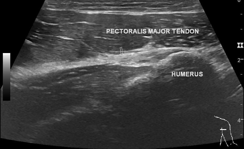 Ultrasound Pectoralis Major Aliem