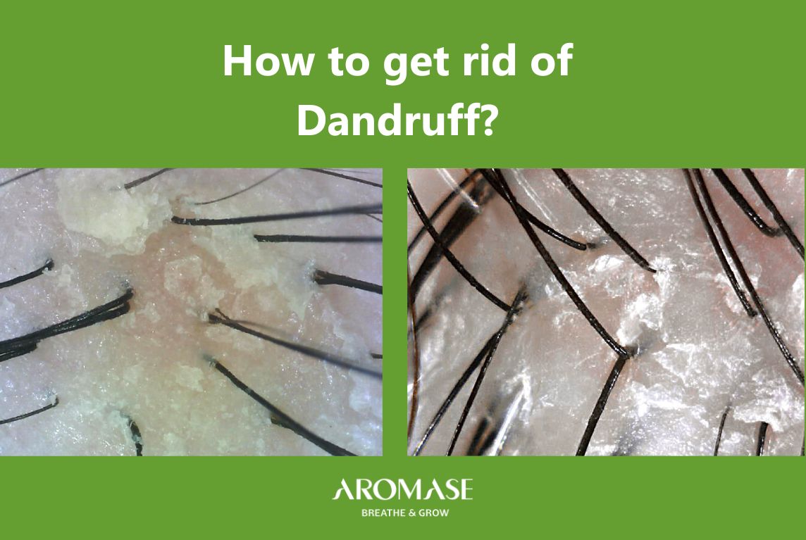 How To Get Rid Of Dandruff Tips For Oily Dandruff And Dry Dandruff Aromase