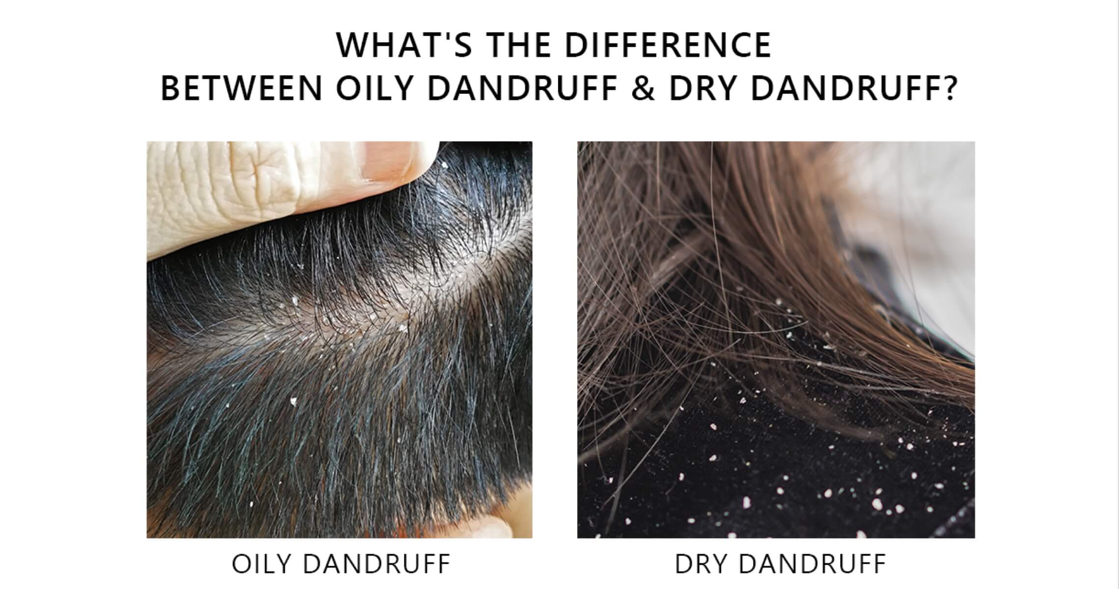 Oily Dandruff Vs Dry Dandruff Causes Differences Symptoms Photos