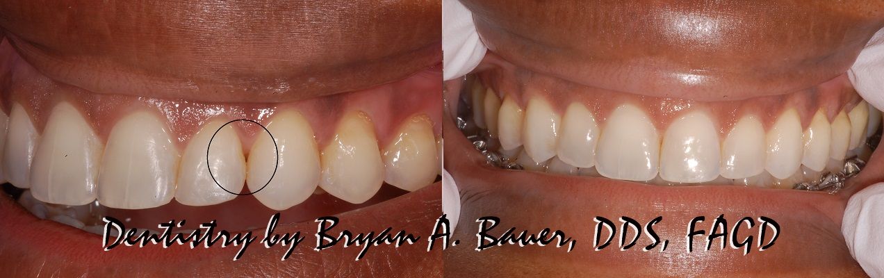 Black Triangle Teeth Treatment Options Bauer Smiles