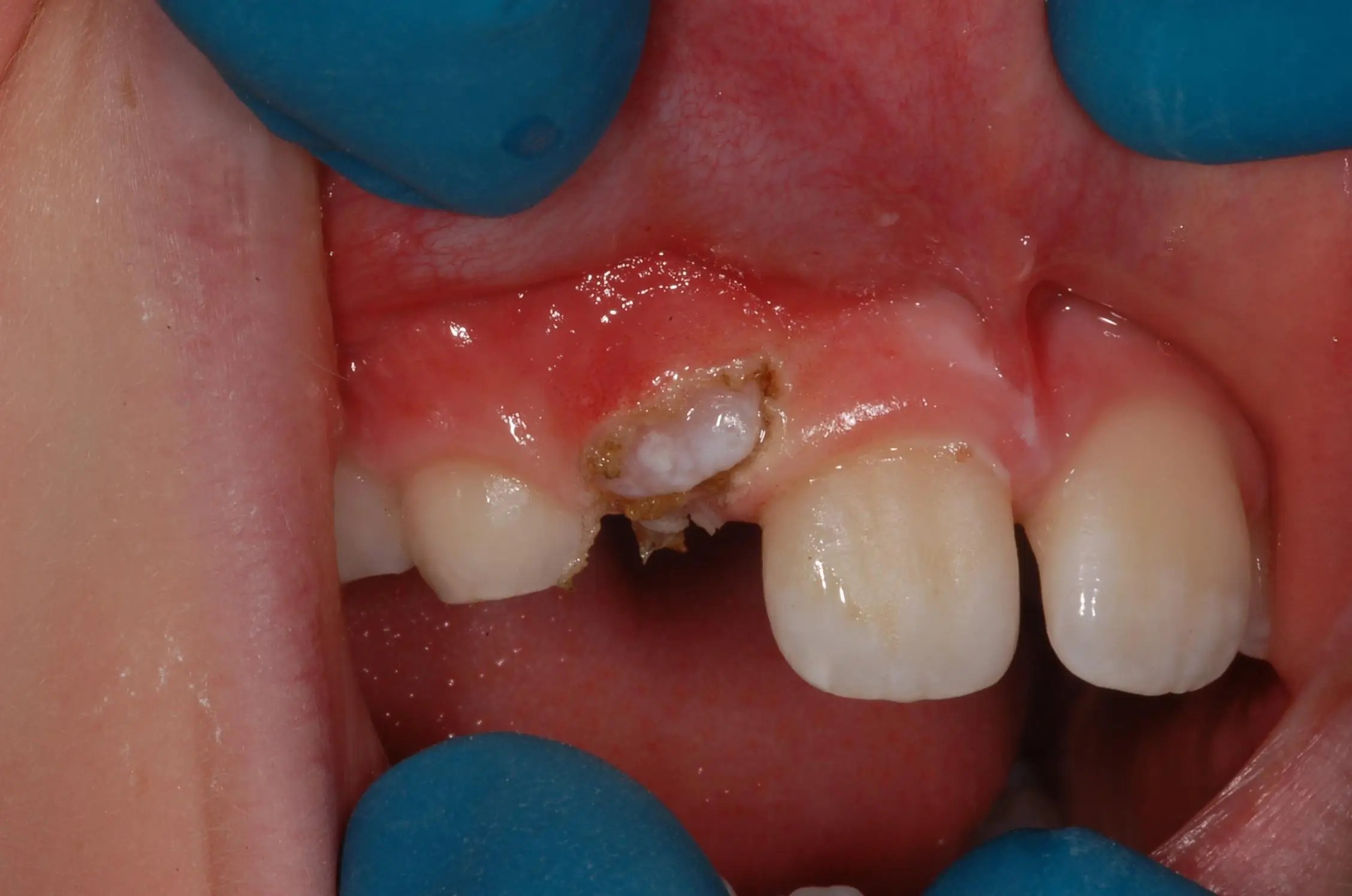 Impacted Canine Tooth Need Impacted Canine Tooth Surgery