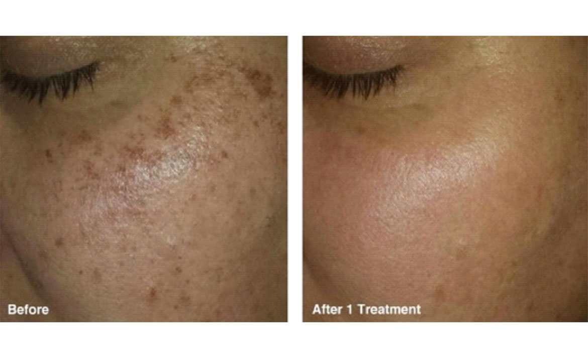 Skin Pigmentation Treatment How Regents Our App