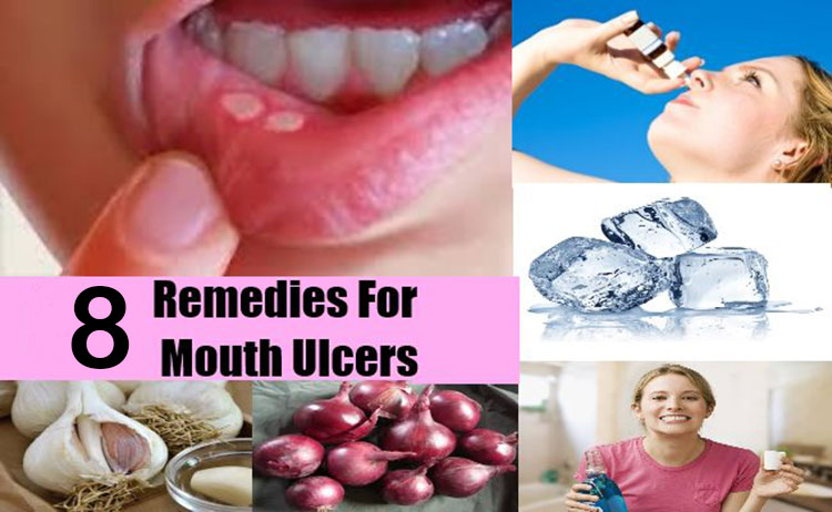 8 Home Remedies To Treat Mouth Ulcers Naturally Best Herbal Health