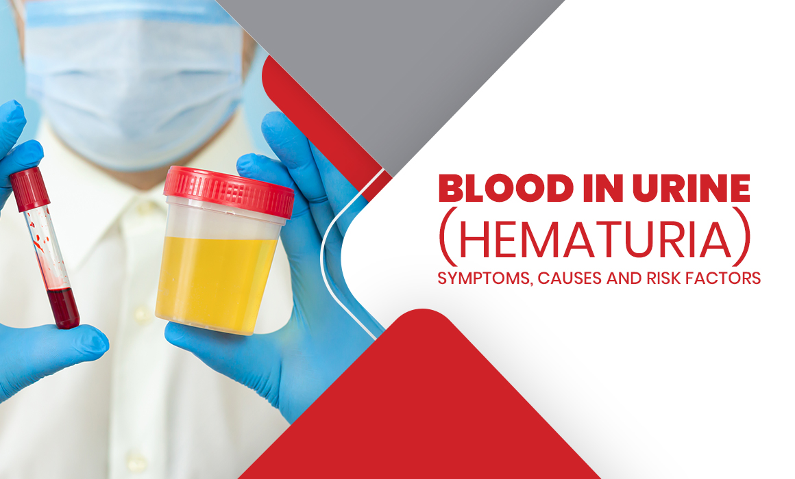 Hematuria Symptoms Causes Risk Factorsand Treatment
