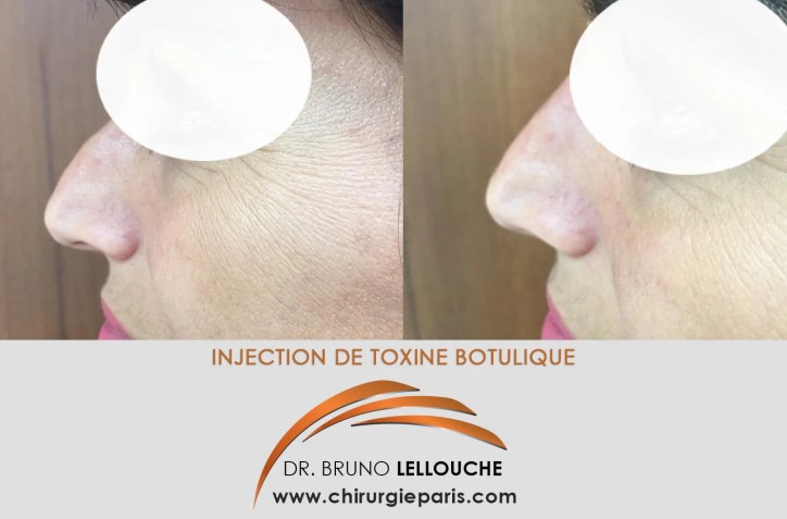 Rhinoplastie Medicale 2 Chirurgie Esthétique De La Face Et Du Cou à