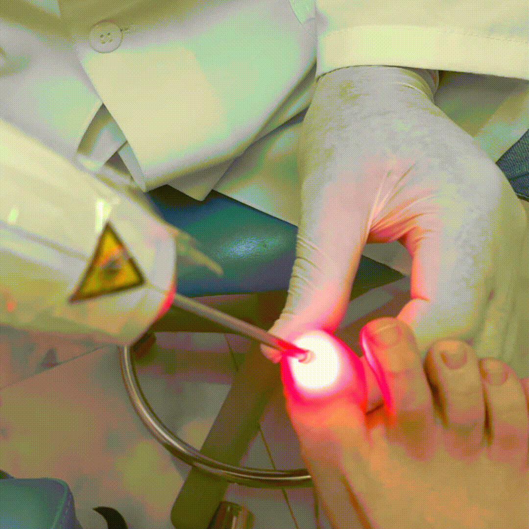 Conheça Os Benefícios Da Laserterapia Na Podologia Clínica Dos Pés