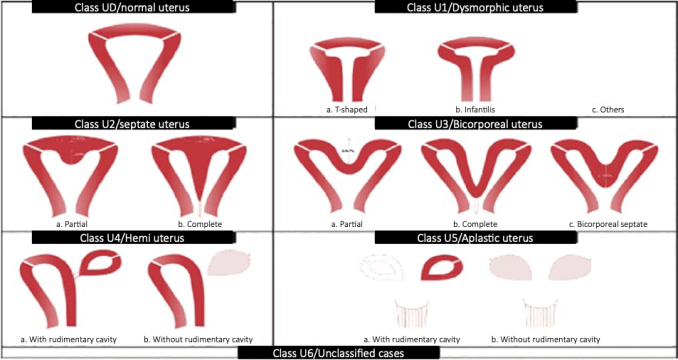 Malformaciones Del Aparato Genital Femenino Clínica Ginecológica Abehsera