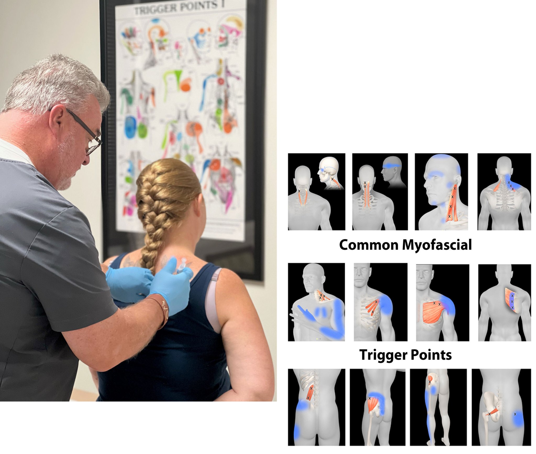 Trigger Point Injections Coastal Virginia Spine And Pain Center