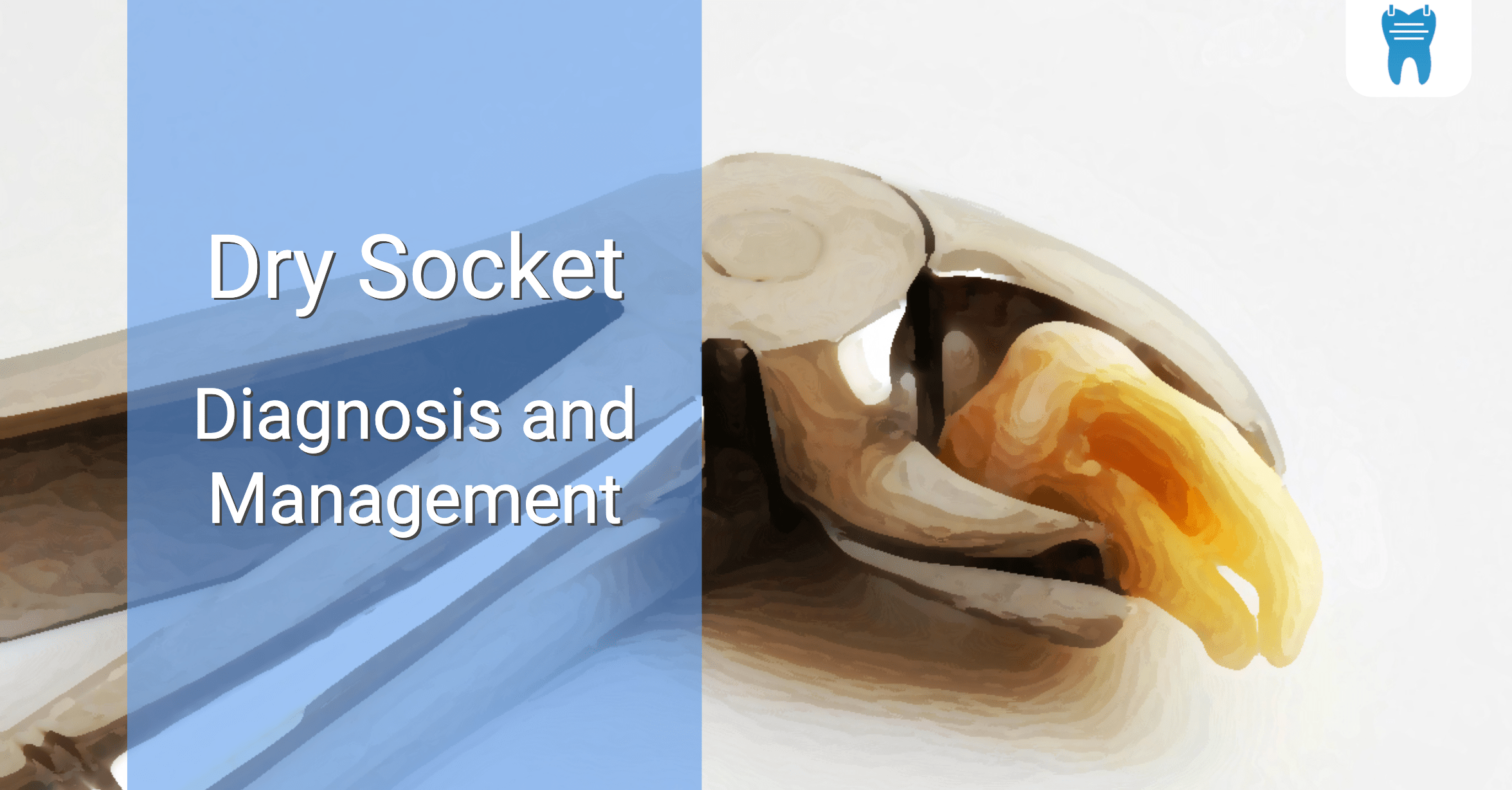 Dry Socket Diagnosis And Management Dentalnotebook