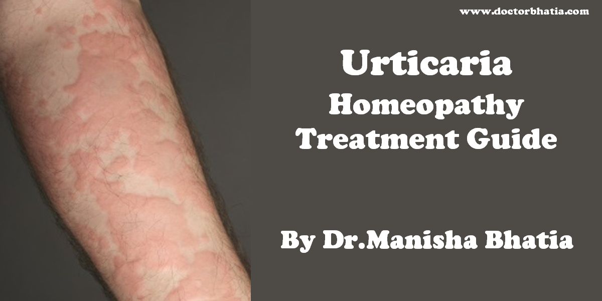 Urticaria Homeopathy Treatment And Homeopathic Remedies 2022