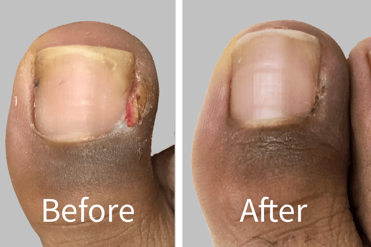 How To Tell If You Have An Ingrown Toenail An Ingrown Toenail Is A