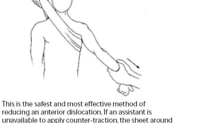 Dr Mohrs Method Anterior Shoulder Dislocation Reduction Otosection