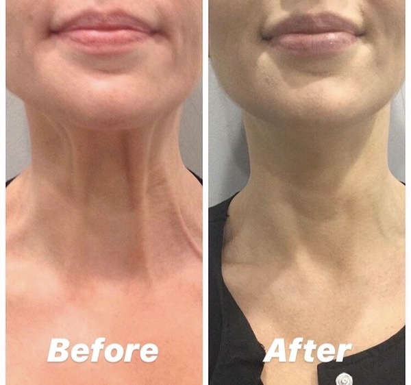 Neck Botox To Treat Neck Lines And Wrinkles The Complete Guide