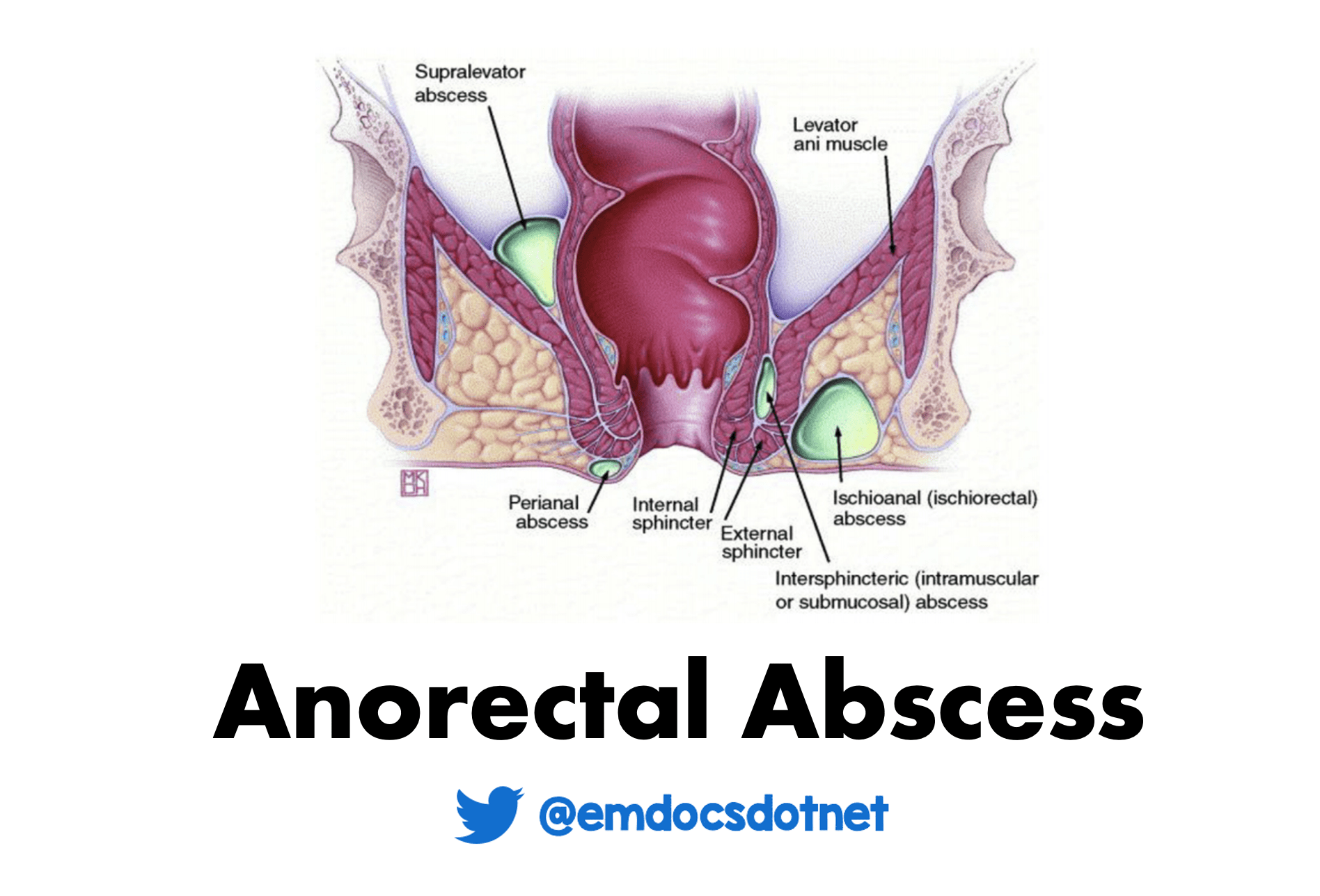 Emergency Medicine Educationanorectal Abscesses Ed